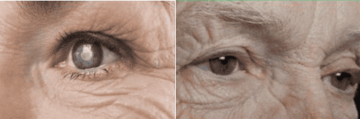 Vision Changes in Dementia: A Caregiver’s Guide