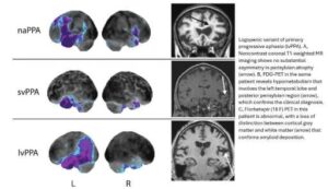 Logopenic Primary Progressive Aphasia: A Comprehensive Guide